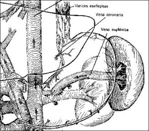 HIPERTENSIÓN PORTAL – Cátedra de cirugía